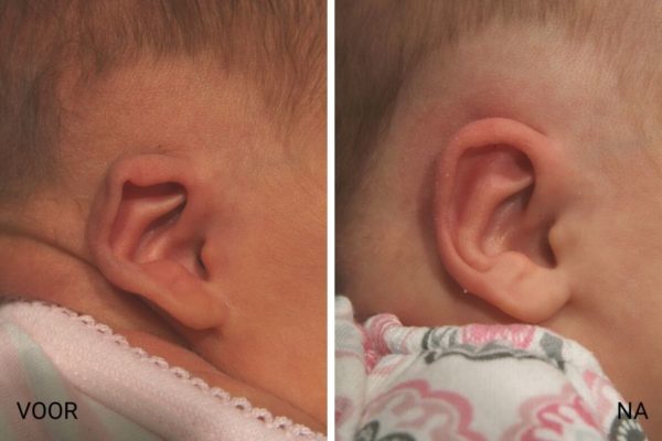 Vervormde oren: baby met misvormde oren behandelen - EarWell