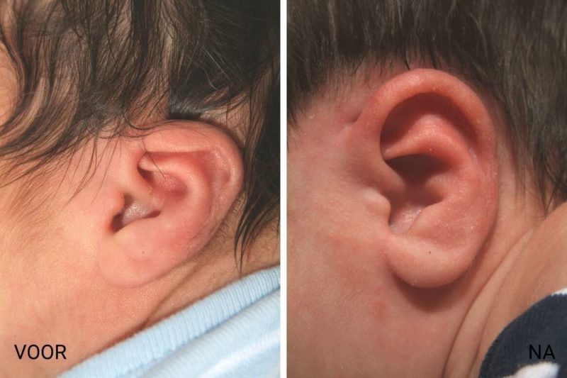 Vervormde oren: baby met misvormde oren behandelen - EarWell Vervormde oren: baby met misvormde oren behandelen - EarWell