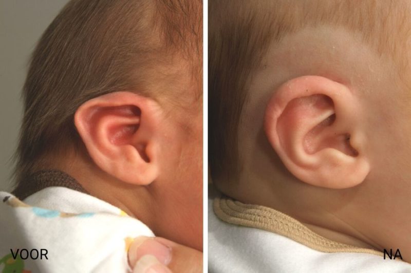 Vervormde oren: baby met misvormde oren behandelen - EarWell Vervormde oren: baby met misvormde oren behandelen - EarWell