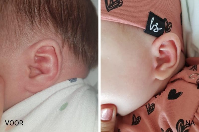 Conchal crus: zwelling of bolling in het oor - EarWell.nl