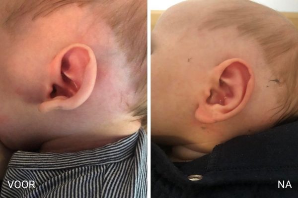 Flaporen baby: Afstaand oor corrigeren zonder operatie - EarWell.nl